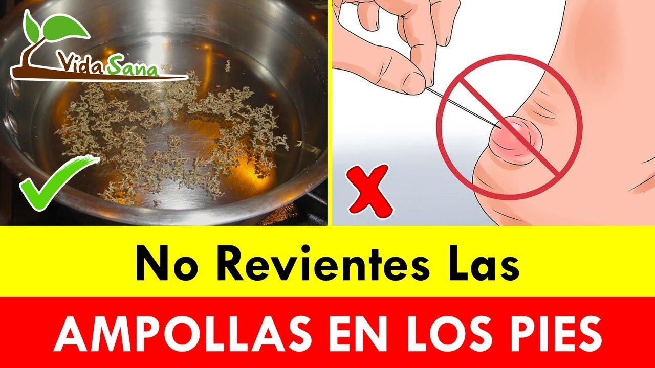 Cómo Curar una Ampolla o Rozadura Con Remedios Naturales - Vida Sana ...
