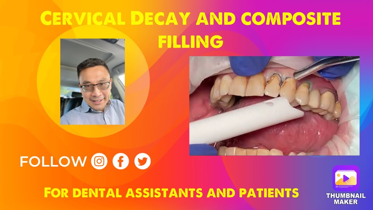 Original Cervical Decay and Composite restoration - YouTube