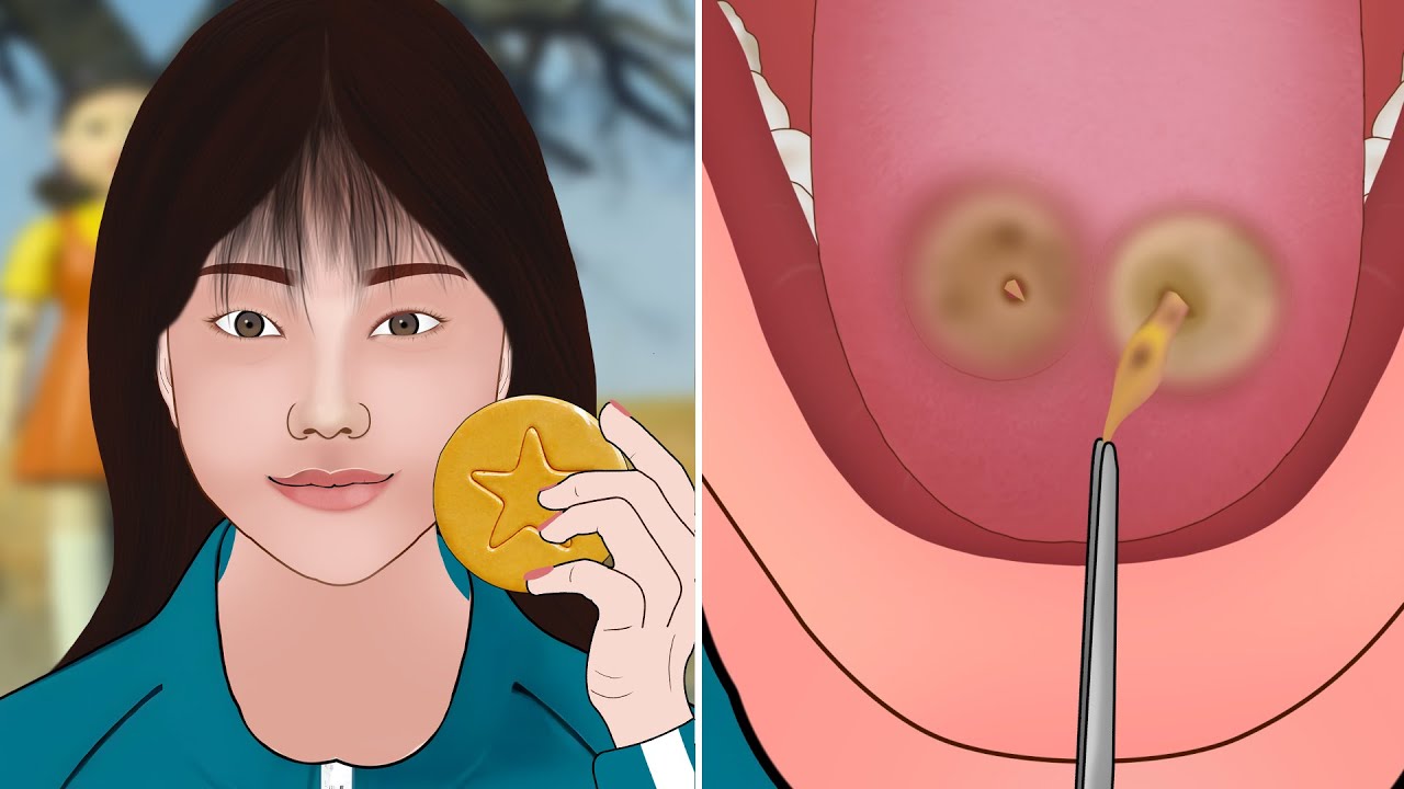 ASMR Animation Squid Game Player 222 Tongue Piercing Infection ...