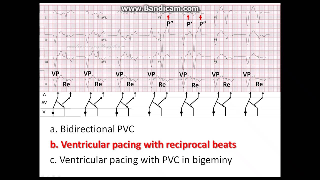 ECG case - Ventricular pacing plus somethinng - YouTube