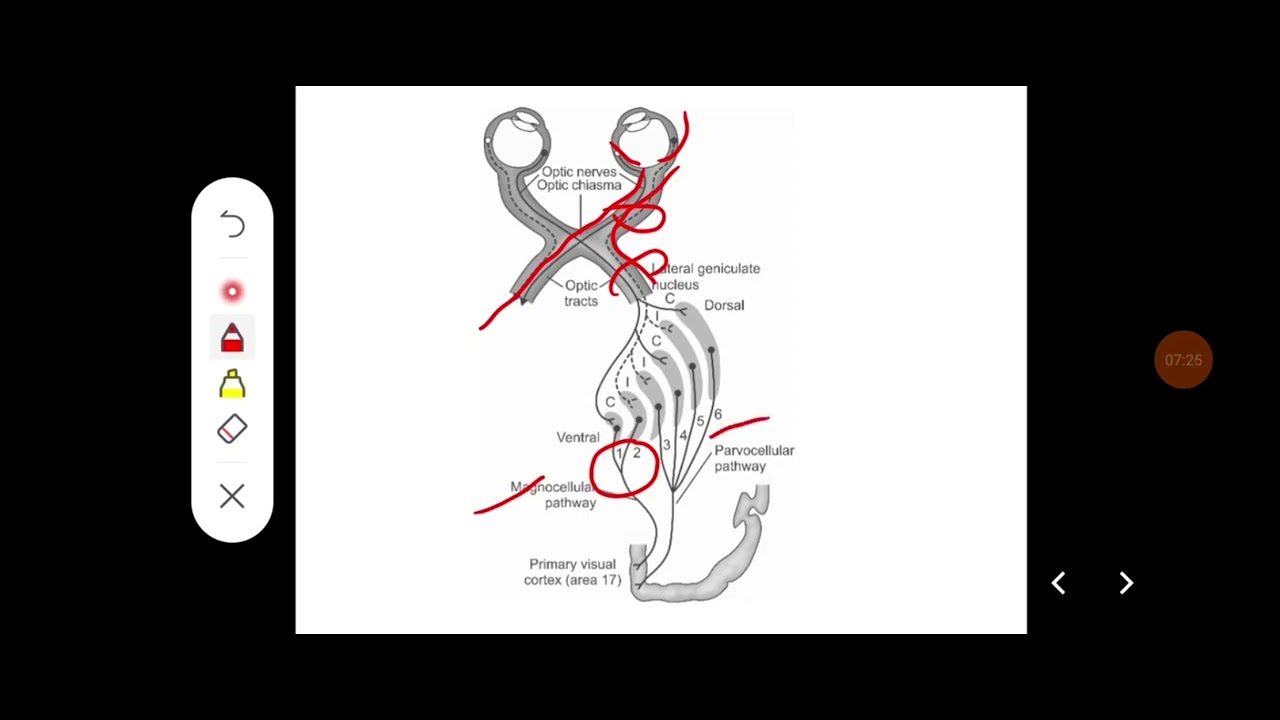 Q. Describe visual pathway. Discuss about effect of lesion at various ...