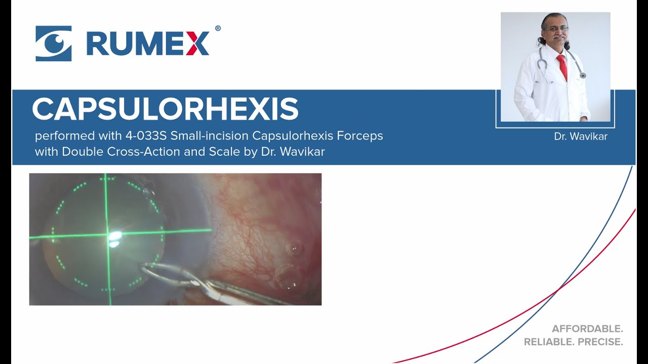 Capsulorhexis performed by Dr. Wavikar with Small-incision ...