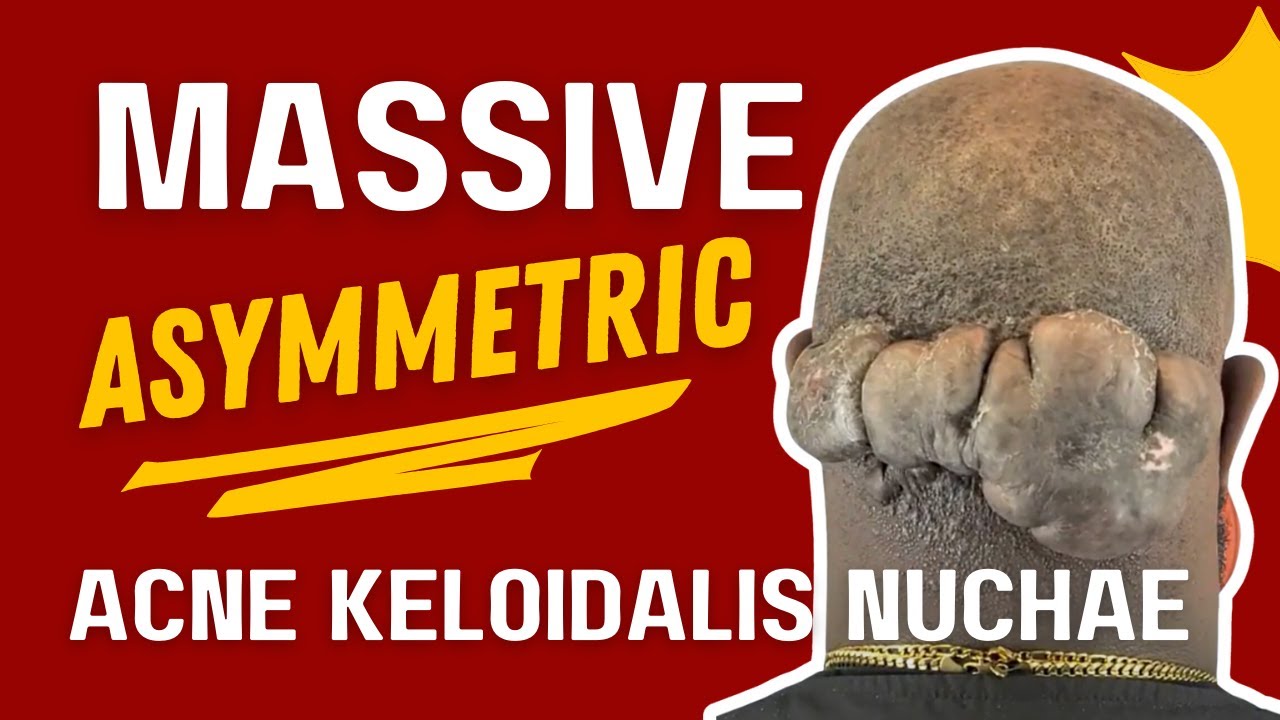 Removing a MASSIVE and ASYMMETRIC AKN (Acne Keloidalis Nuchae) - Dr. U ...