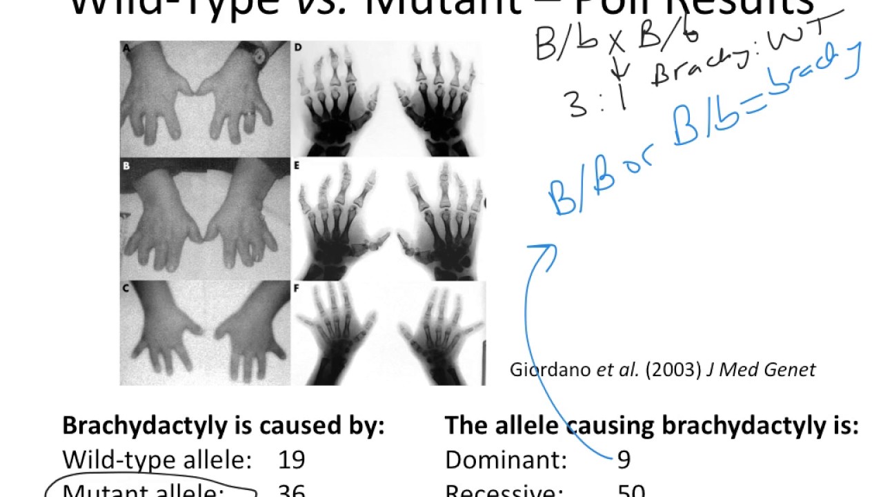 brachydactyly - YouTube
