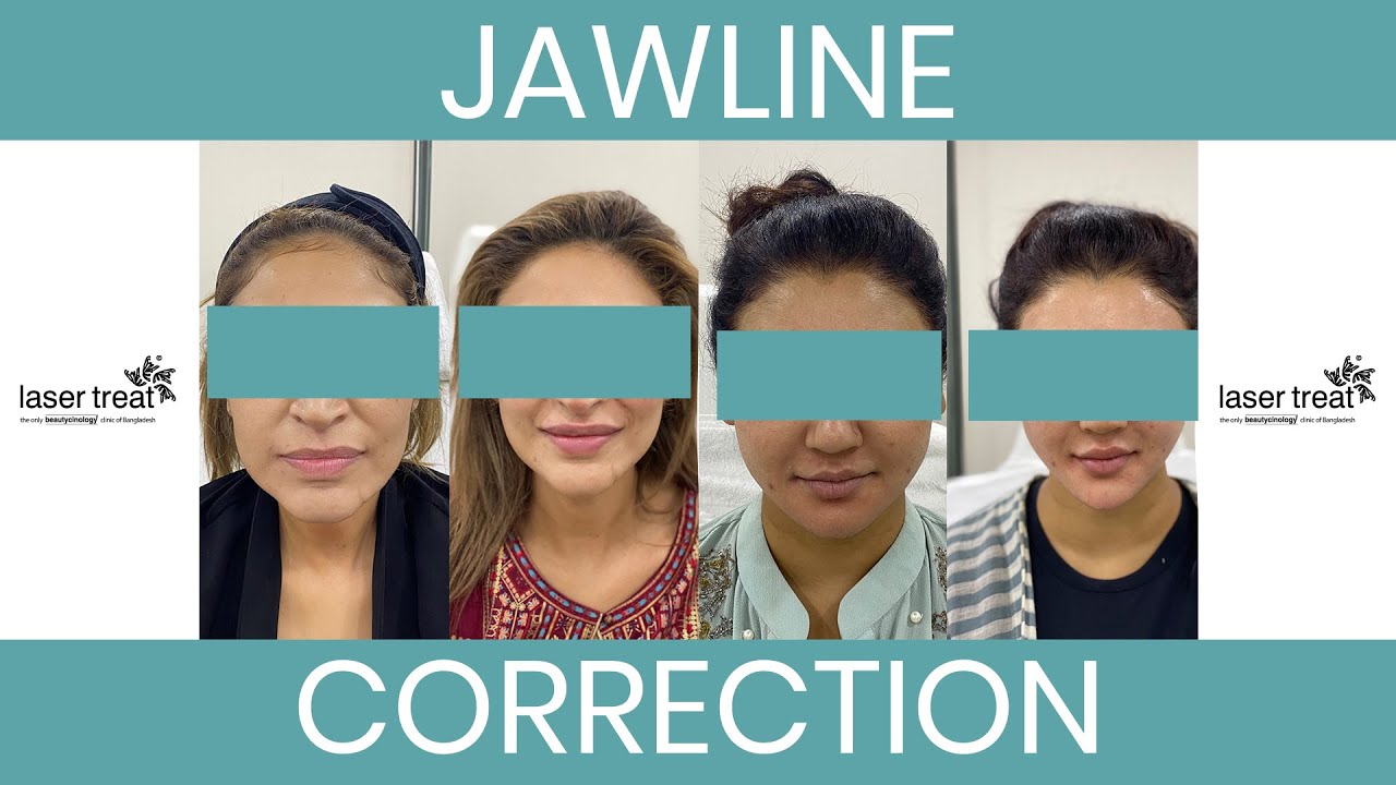 Jaw line Correction | Non-surgical jawline reshaping | Laser Treat | Dr ...