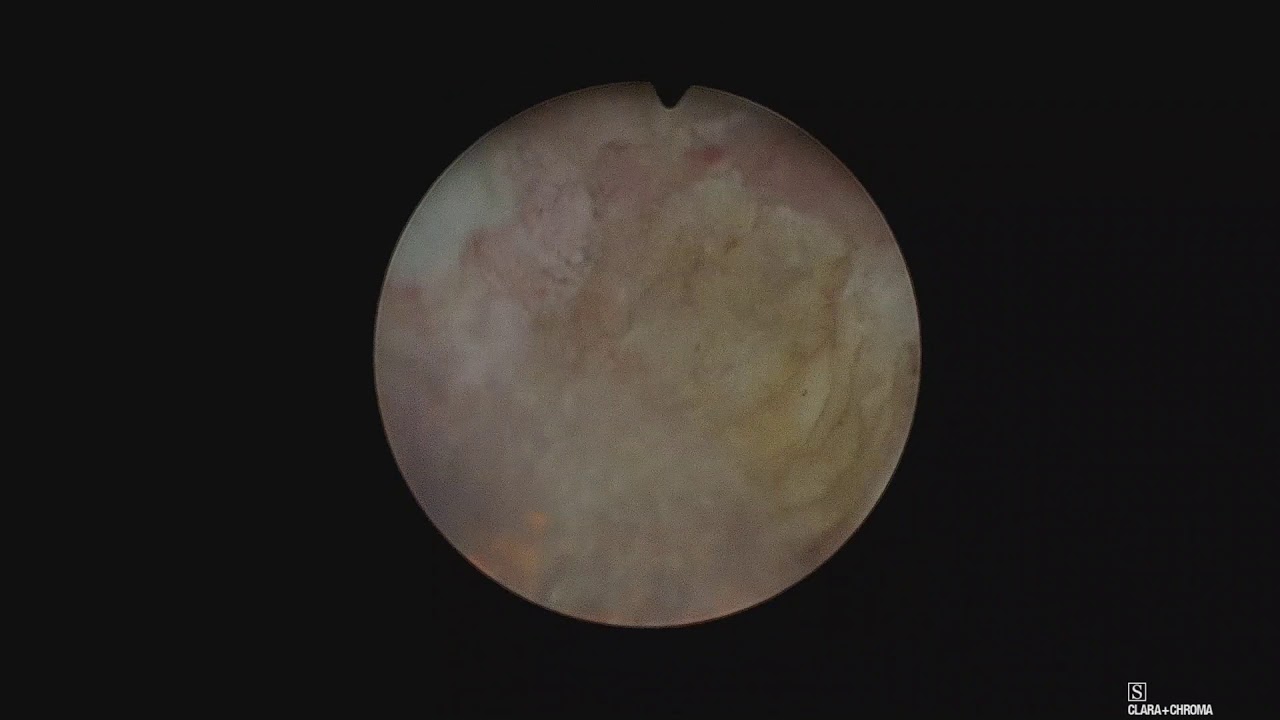 hysteroscopic myomectomy , Dr Basel Jallad - YouTube