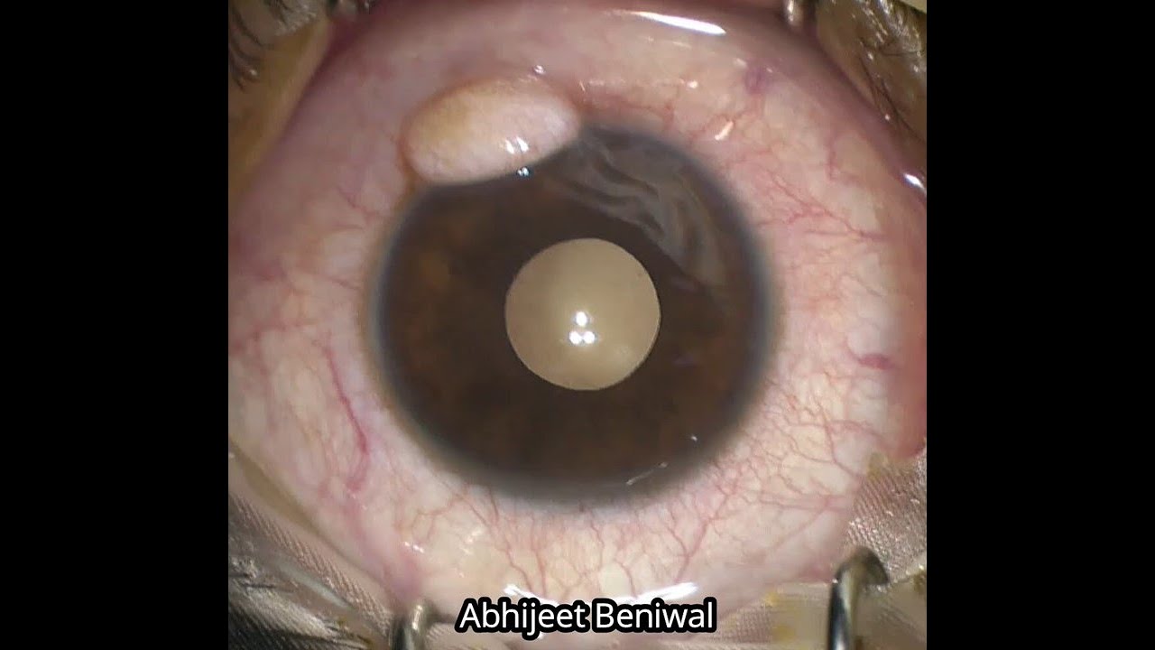 Dermoid excision with customized lamellar patch graft - YouTube