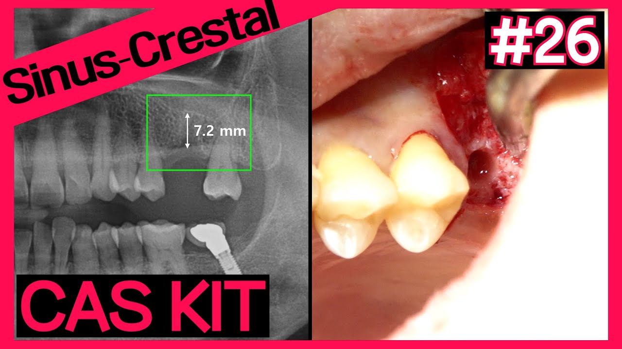 [Online Surgery] Easy Sinus Elevation with CAS KIT - YouTube