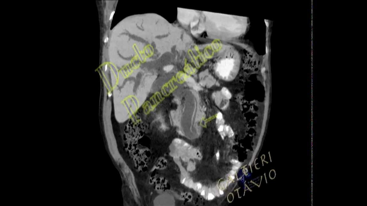 DILATAÇÃO DE VIAS BILIARES / TOMOGRAFIA 3D - MPR - YouTube