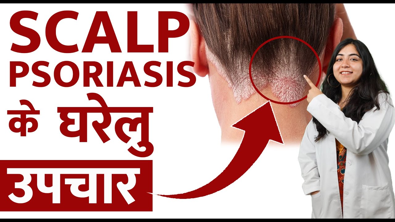 Scalp Psoriasis Removal Home Remedies in Hindi - YouTube