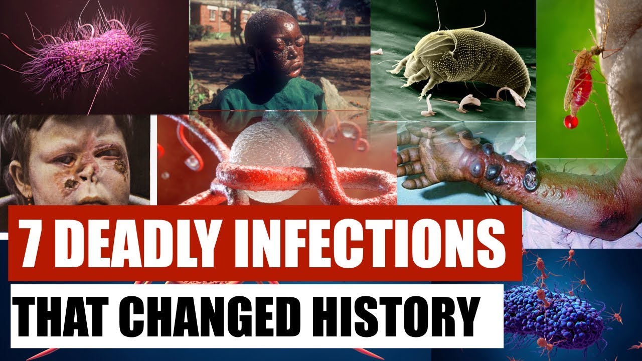 TOP 7 DEADLIEST INFECTIONS THAT CHANGED HISTORY - YouTube