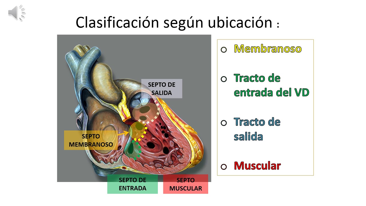 Tabique Interventricular