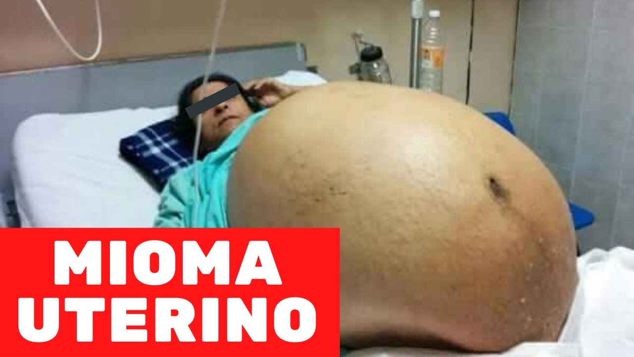 MIOMA UTERINO: 5 COISAS QUE VOCÊ PRECISA SABER - YouTube
