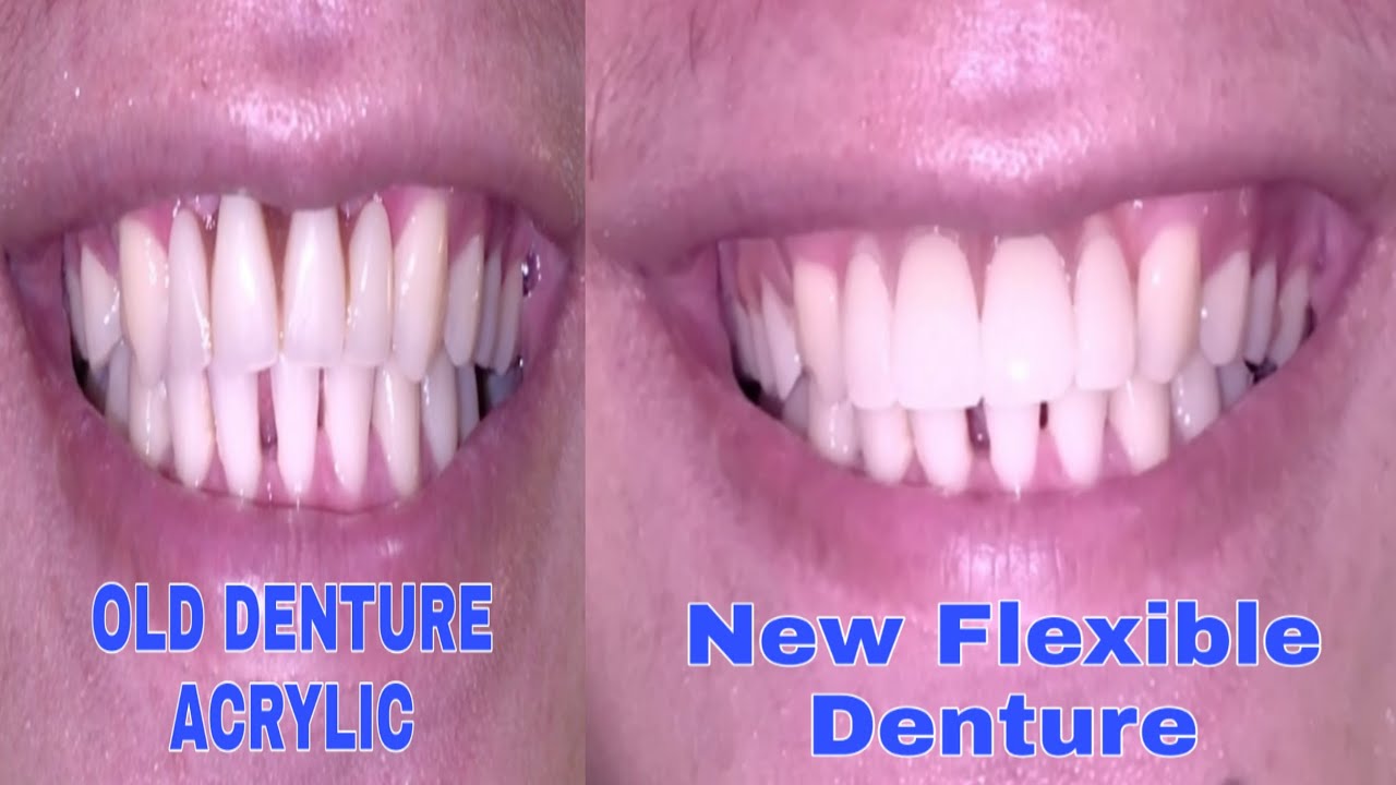 Pustiso before and after Flexible Dentures and acrylic dentures ...