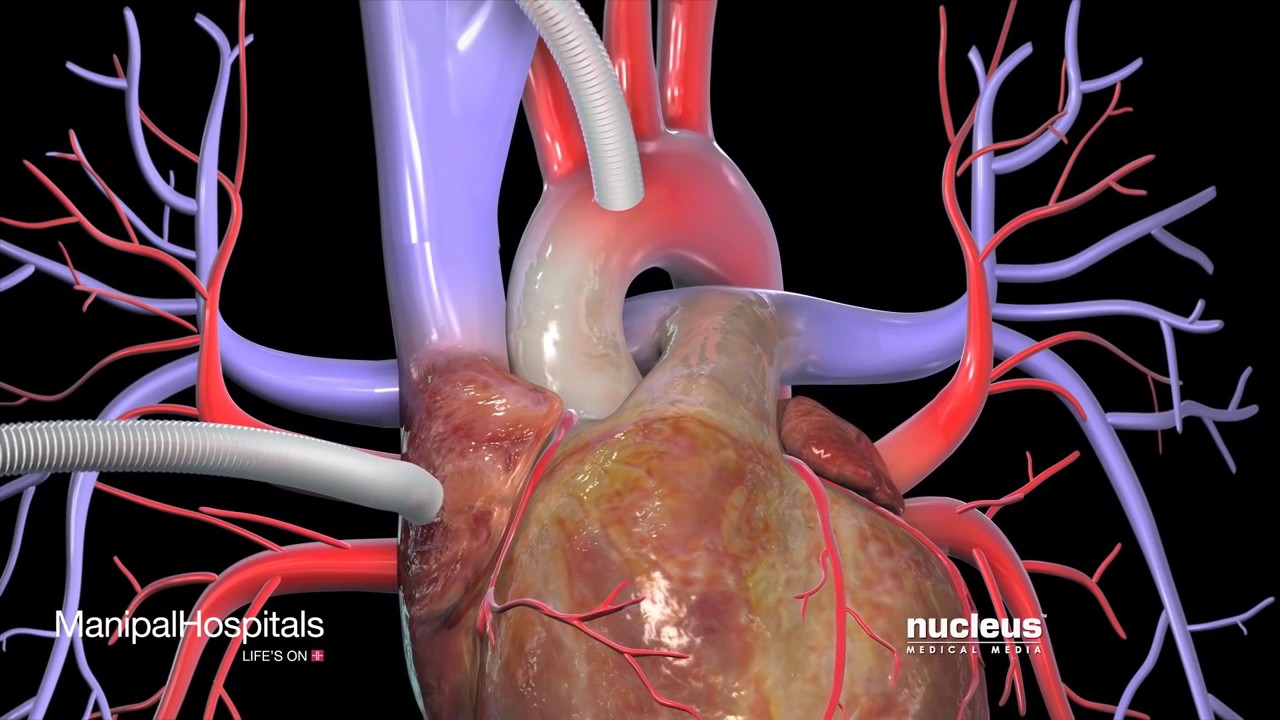 How Coronary Artery Bypass Surgery Works YouTube