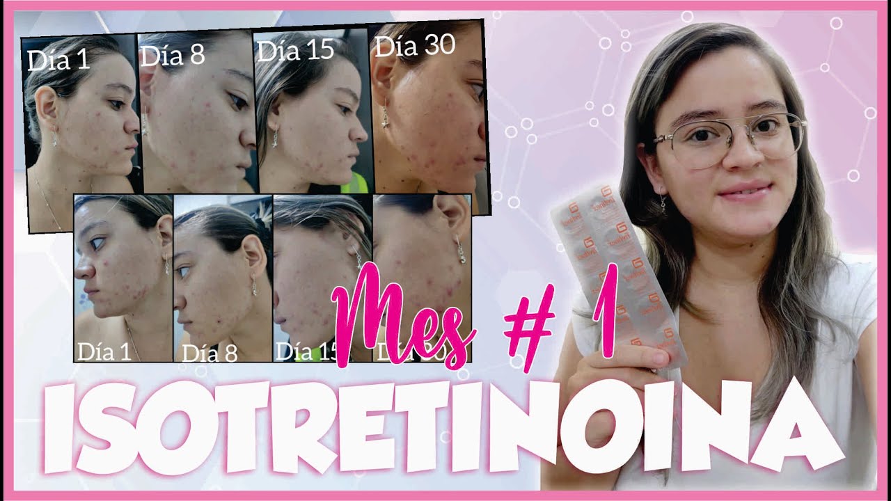 MES 1 ISOTRETINOINA l TRATAMIENTO - YouTube