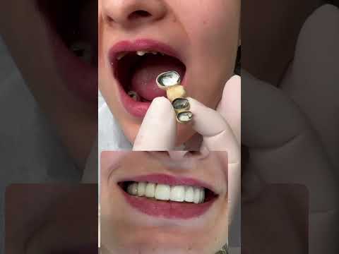 Canlar Zirkon yapmadan iyi düşünün #dentist #smiledesigndental #laminediş #zirkonyum #zirkonyumdiş