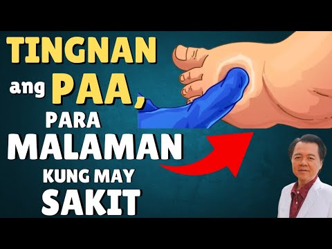 Tingnan ang Paa Para Malaman ang akit. - By Doc Willie Ong (Internist ...