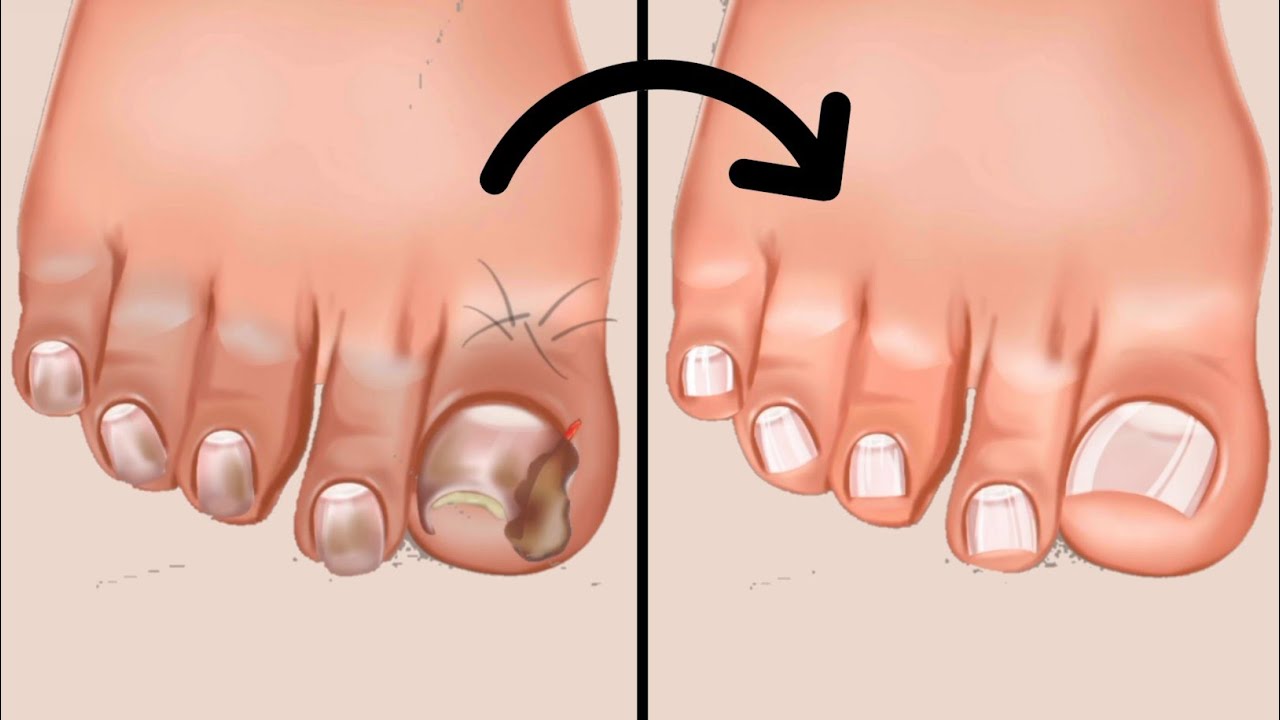 ASMR Animation! Ingrown toenail removal Treatment Animation - YouTube
