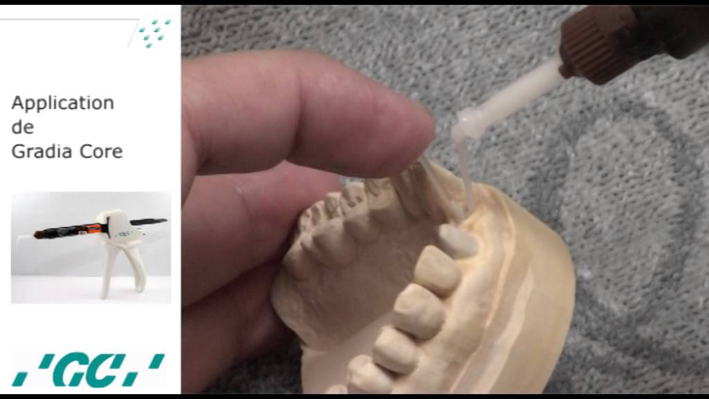 Réalisation Inlay Core esthétique avec Gradia Core #2 - YouTube