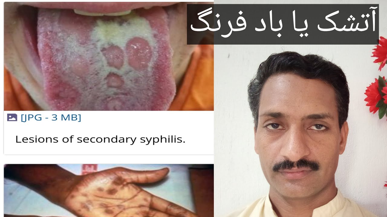 Syphilis chancre it's causes symptoms and homeopathic treatment - YouTube