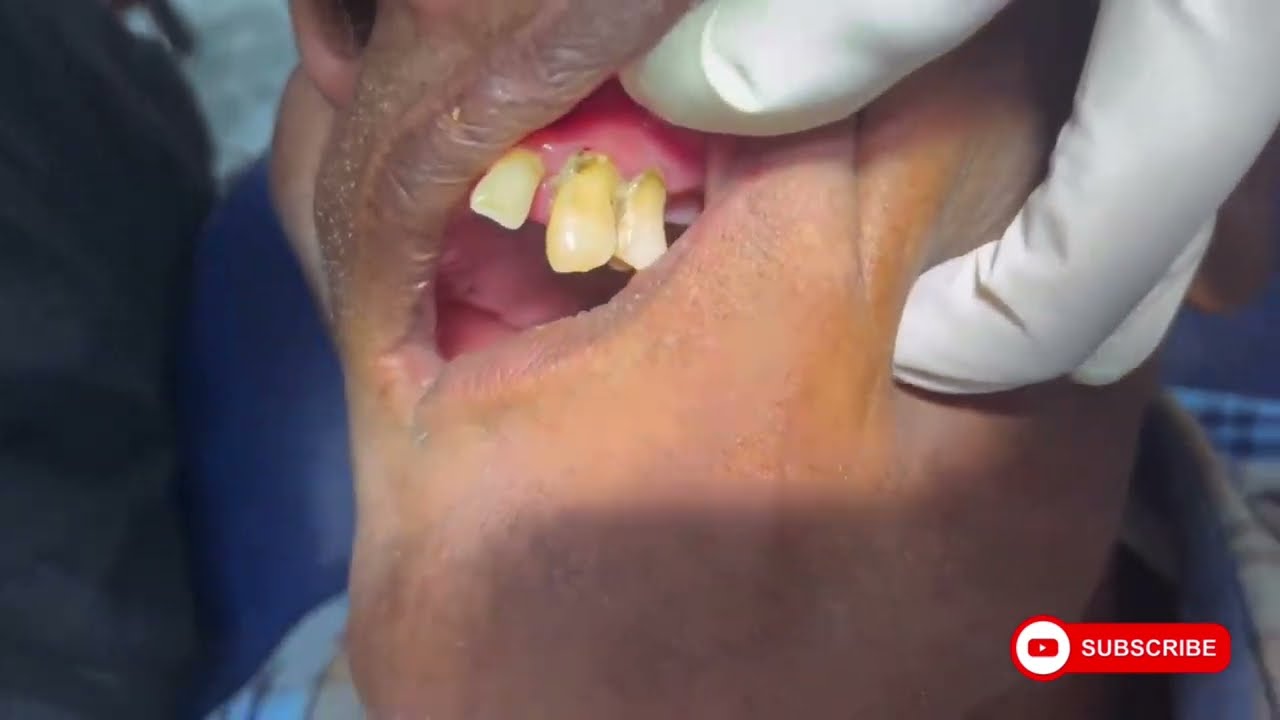 Maxillary anterior extraction l upper anterior extraction #dentistry # ...