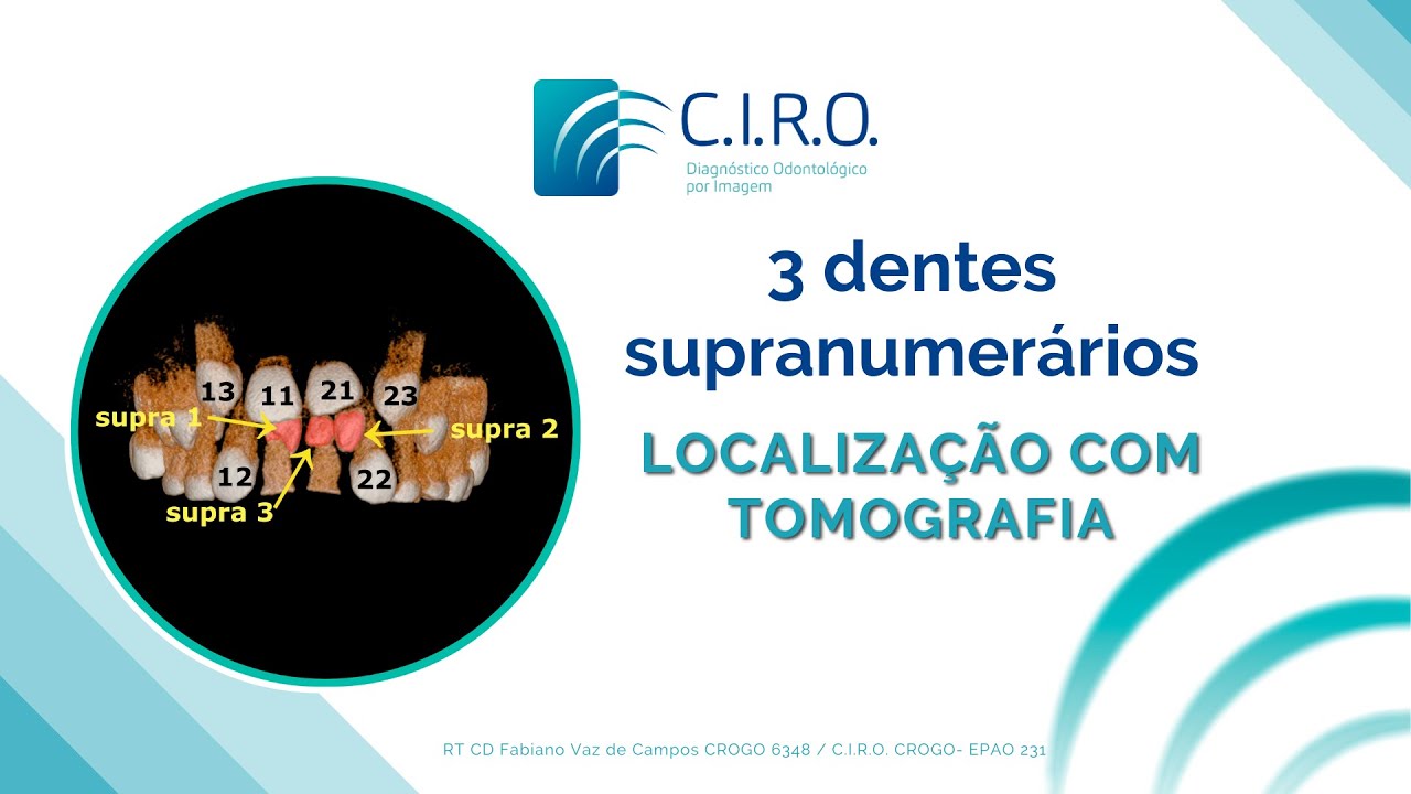 Três dentes supranumerários em maxila - YouTube