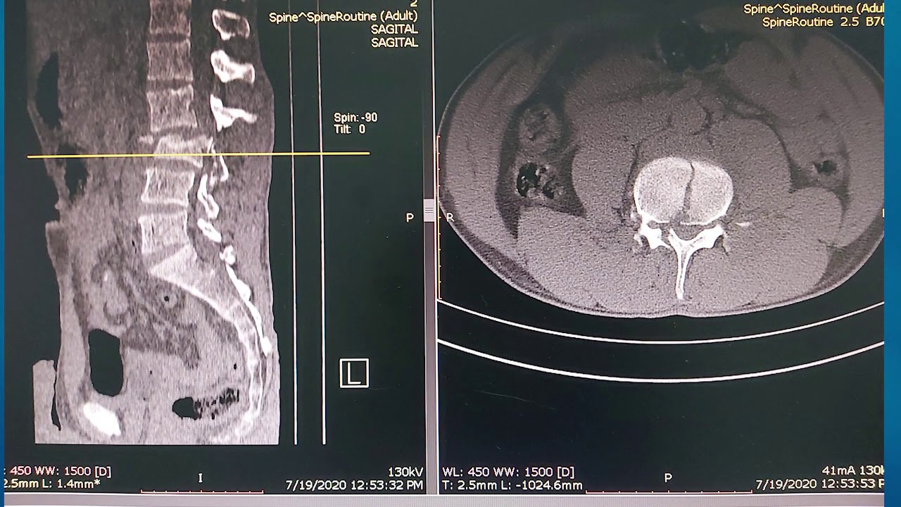 Dr Armend Agolli Rasti Qerqiz Rama - YouTube