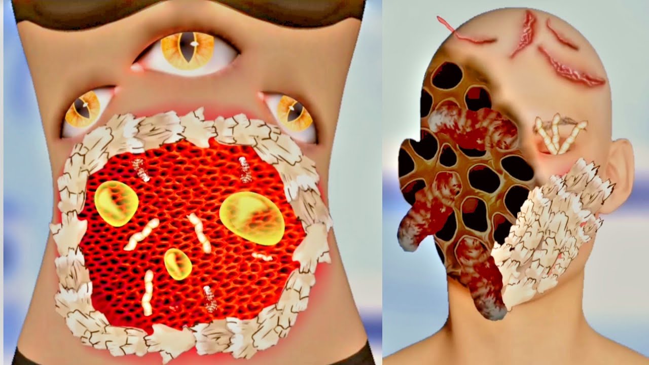 Trypophobia Collection,Treating Parasitic Eyes and Extreme Face Worm ...