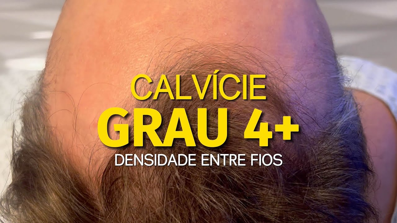 CALVÍCIE GRAU 4+ - DENSIDADE ENTRE FIOS - YouTube