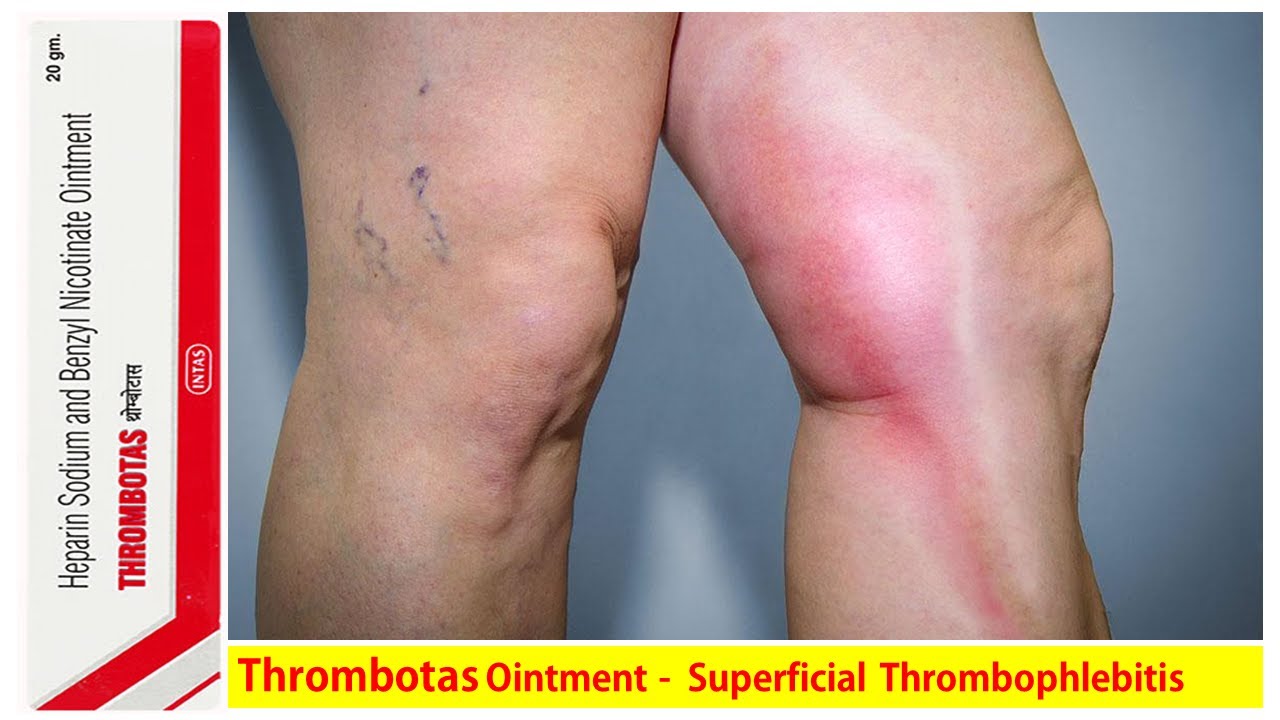 Thrombotas Ointment | Benzyl Nicotinate + Heparin | Treat superficial ...