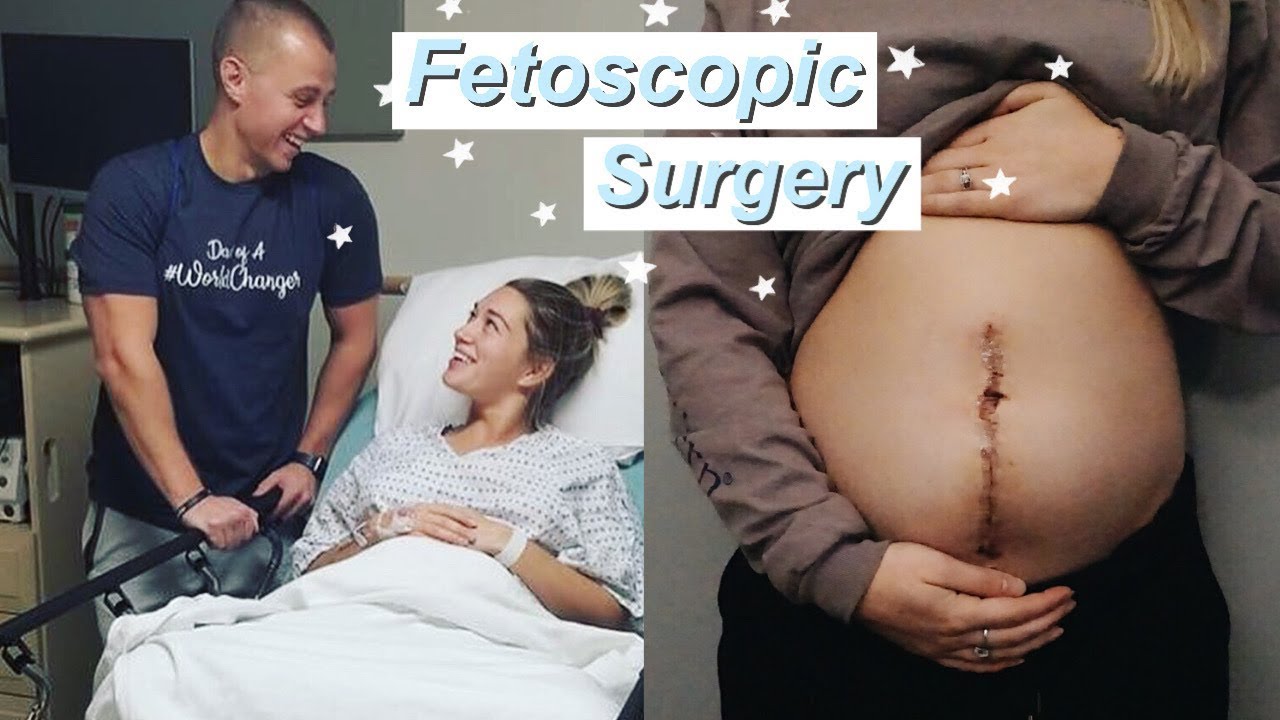 FETOSCOPIC SURGERY VLOG Closing Baby T s Spine AMAZING OUTCOME YouTube FETOSCOPIC SURGERY VLOG Closing Baby T s Spine AMAZING OUTCOME YouTube