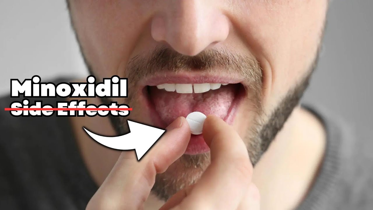 How to Avoid Oral MINOXIDIL Side Effects | with AL GARRIDO - YouTube