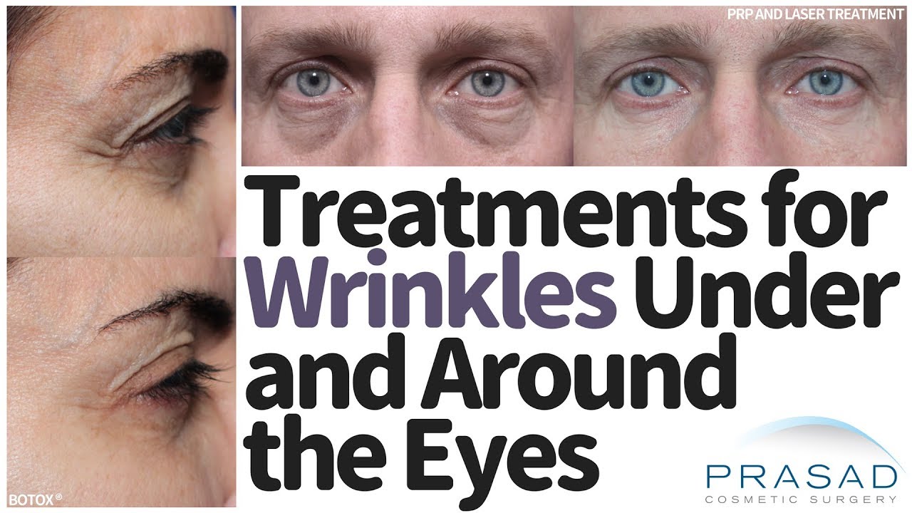 How to Treat Wrinkles Under and Around the Eyes - YouTube