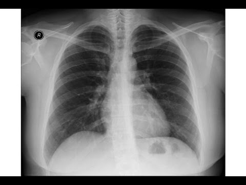Chest x-ray, Eventration of Diaphragm - YouTube