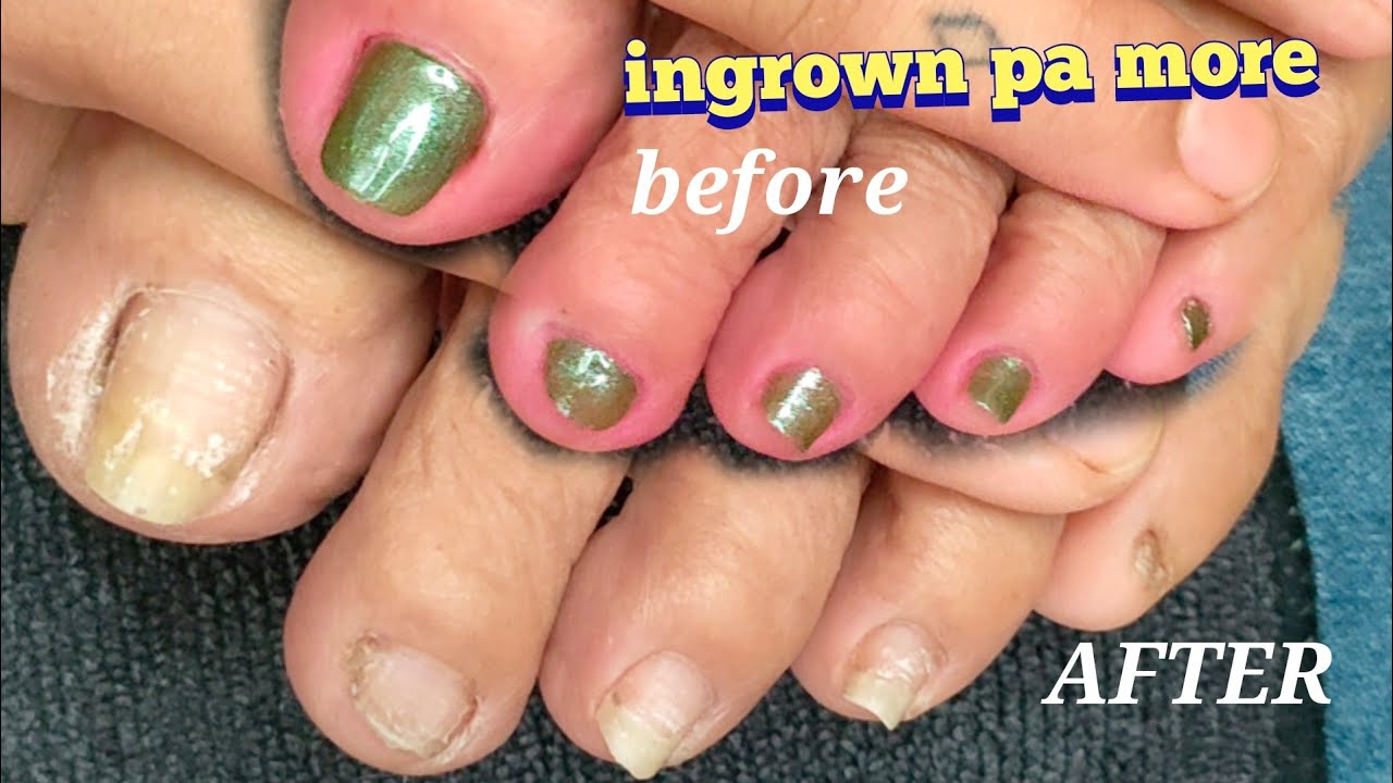 IMPACTED OR INGROWN TOENAIL PEDICURE TUTORIAL 💚 - YouTube