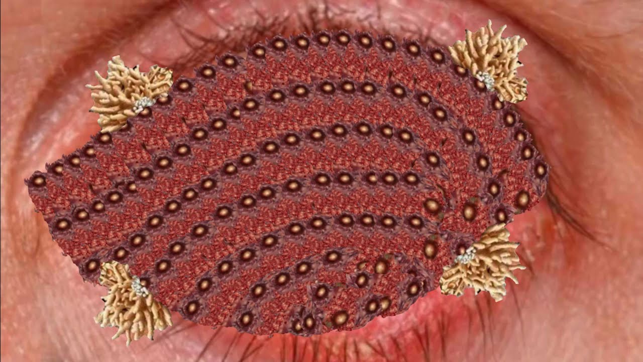 ASMR Remove dog tick , Maggot , spider ,lice ,eyeball from infected arm ...