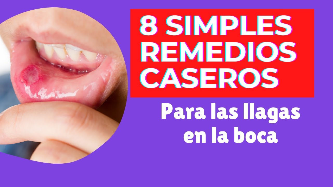 Llagas en la boca | 8 Simples remedios caseros | aftas bucales - YouTube