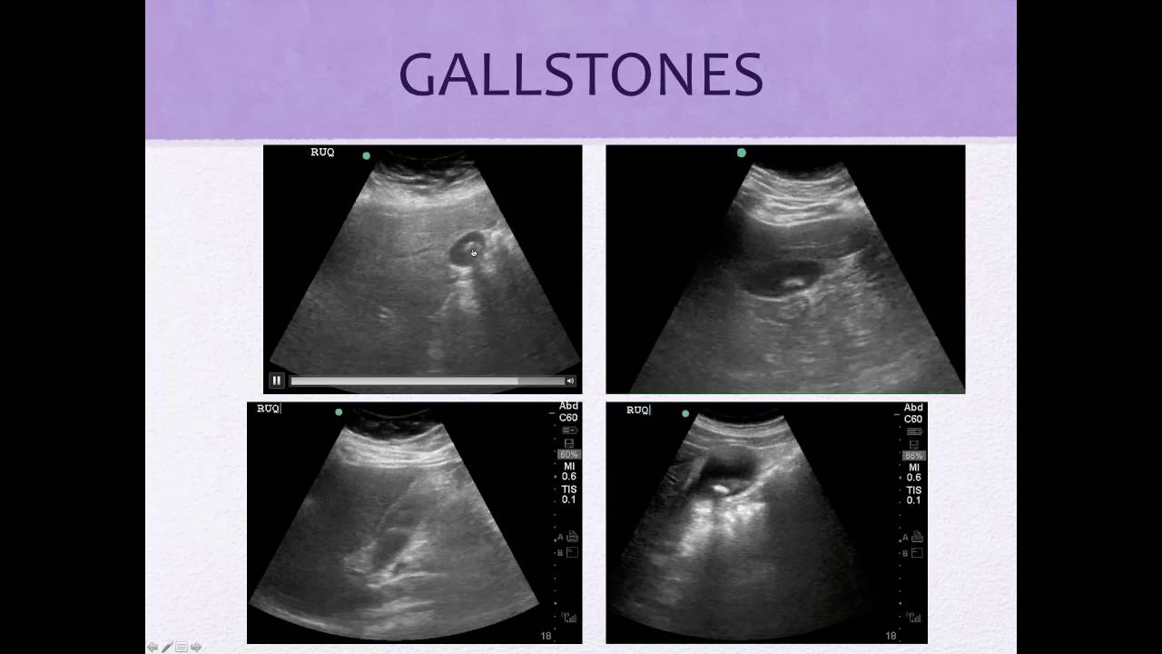 GB Stone Vs Polyp YouTube