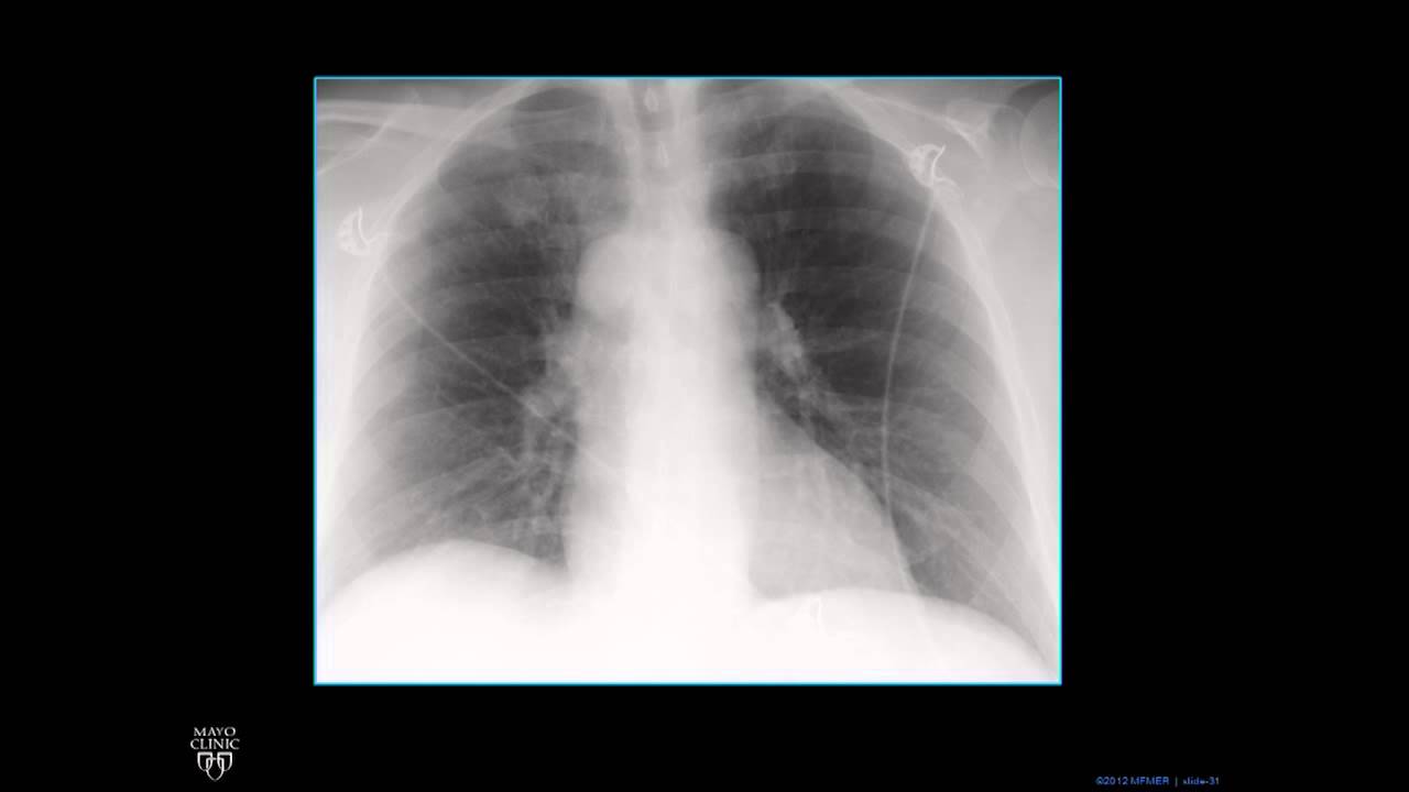 Plain Film Cardiac and Vascular Anatomy - Frontal Radiograph - Philip ...