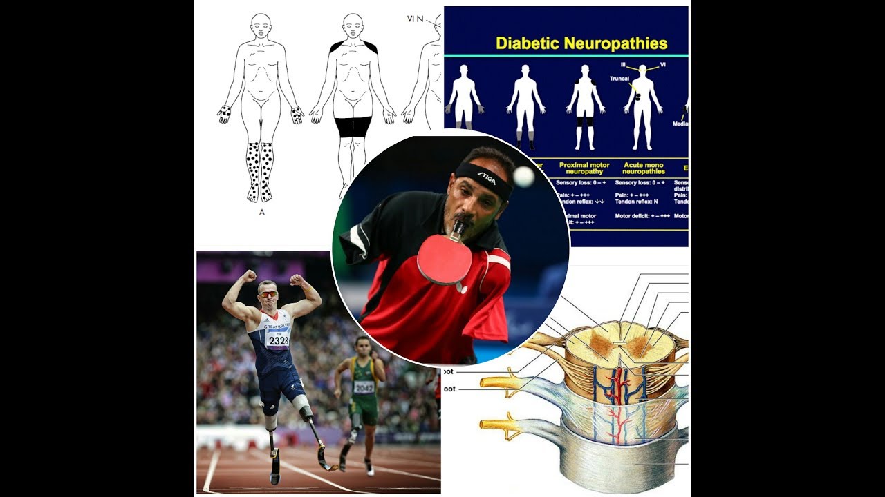 Diabetic Neuropathy ,HMSP( perneal muscle atrophy),GBS( Guillain barre ...