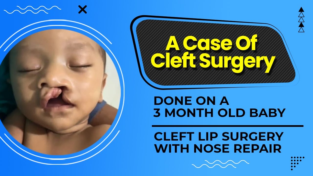 Cleft Surgery Done On A Baby | Cleft Lip Surgery With Nose Repair ...
