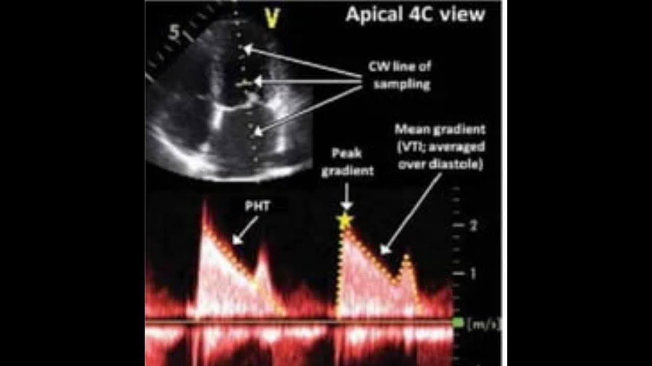 Mitral stenosis Quantification, Gradients, CE, PISA and MV Resistance ...