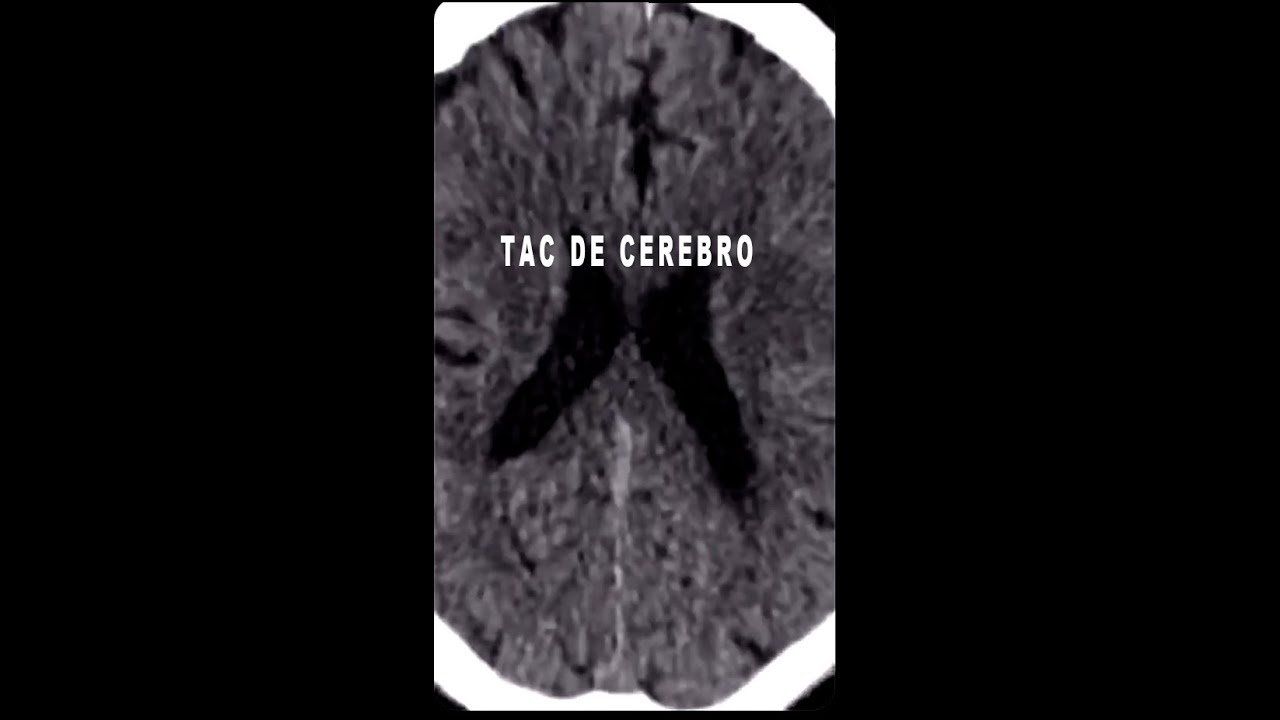 TAC de cerebro NORMAL. Estructuras que pueden observarse - YouTube