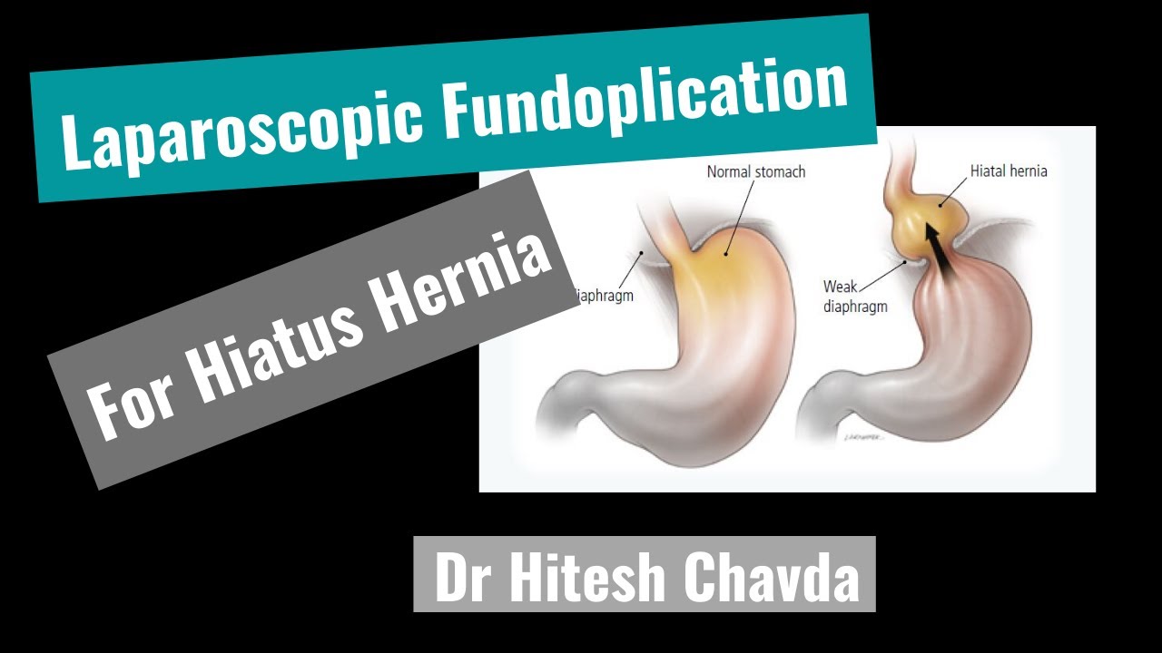 Laparoscopic fundoplication for a large hiatus hernia by Dr Hitesh ...