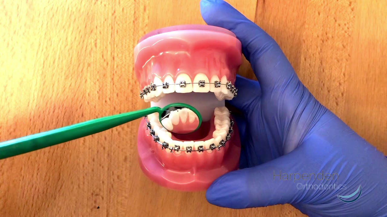 Brace Care For Fixed Braces. - YouTube