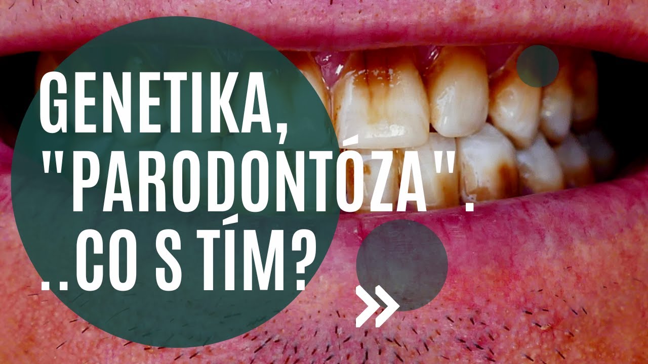 💥 "Parodontóza" a dědičnost.💥 Jak se tomu vyhnout? - YouTube