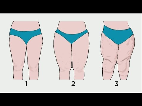 Ovanlig kvinnosjukdom förväxlas med fetma - Nyheterna (TV4)