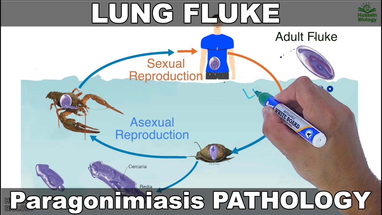 Oriental Lung Fluke Causes Symptoms Treatment Oriental