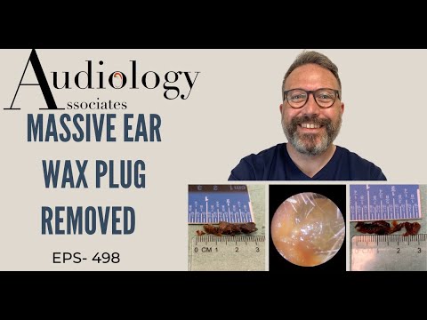MASSIVE EAR WAX PLUG REMOVAL - EP498 - YouTube